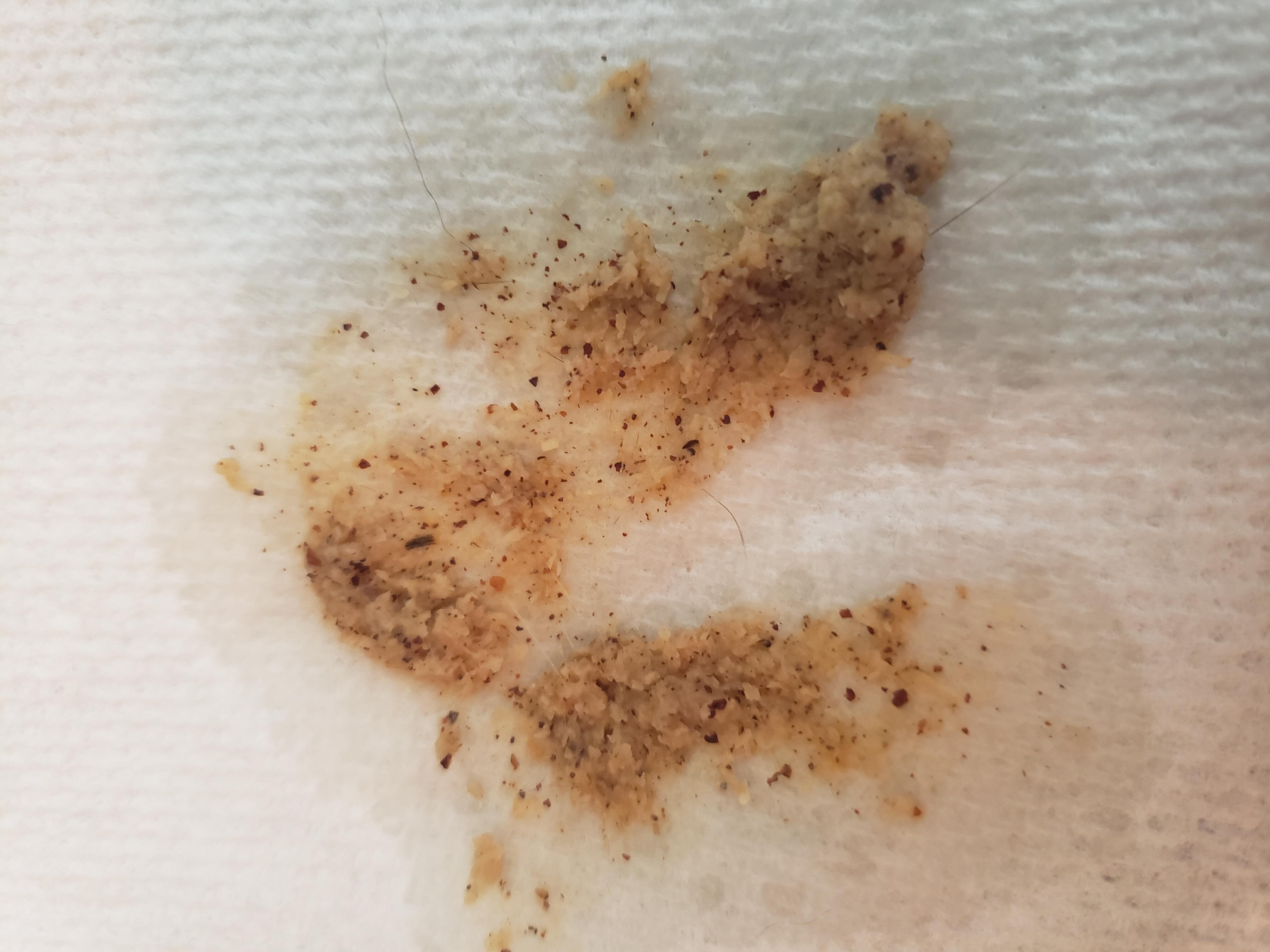 Coffee Ground Vomit Woman With Coffee Ground Emesis Annals Of
